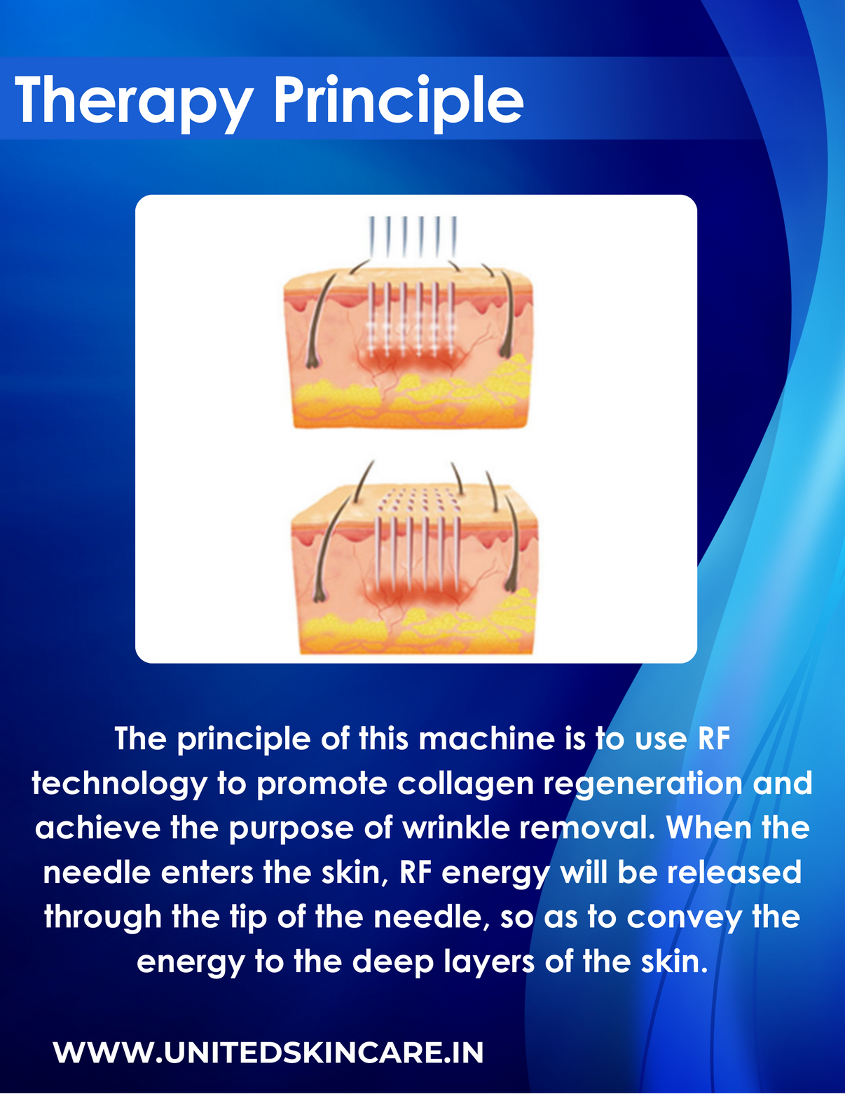 Magnus RF 5 MHZ Machine Quantus ITALY Microneedling Radio Frequency Ma ...