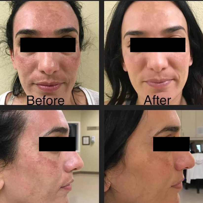 Magnus RF 5 MHZ Machine Quantus ITALY Microneedling Radio Frequency Ma ...